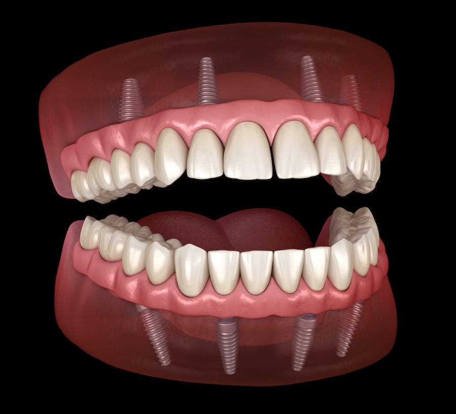 What’s the Best Way to Clean All-on-4 Dental Implants? | Robert J. Freitas II, DDS PC